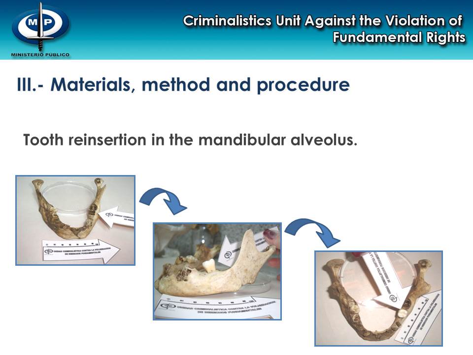Criminalística | Novel Technique of Dental Tissue Collection for ...
